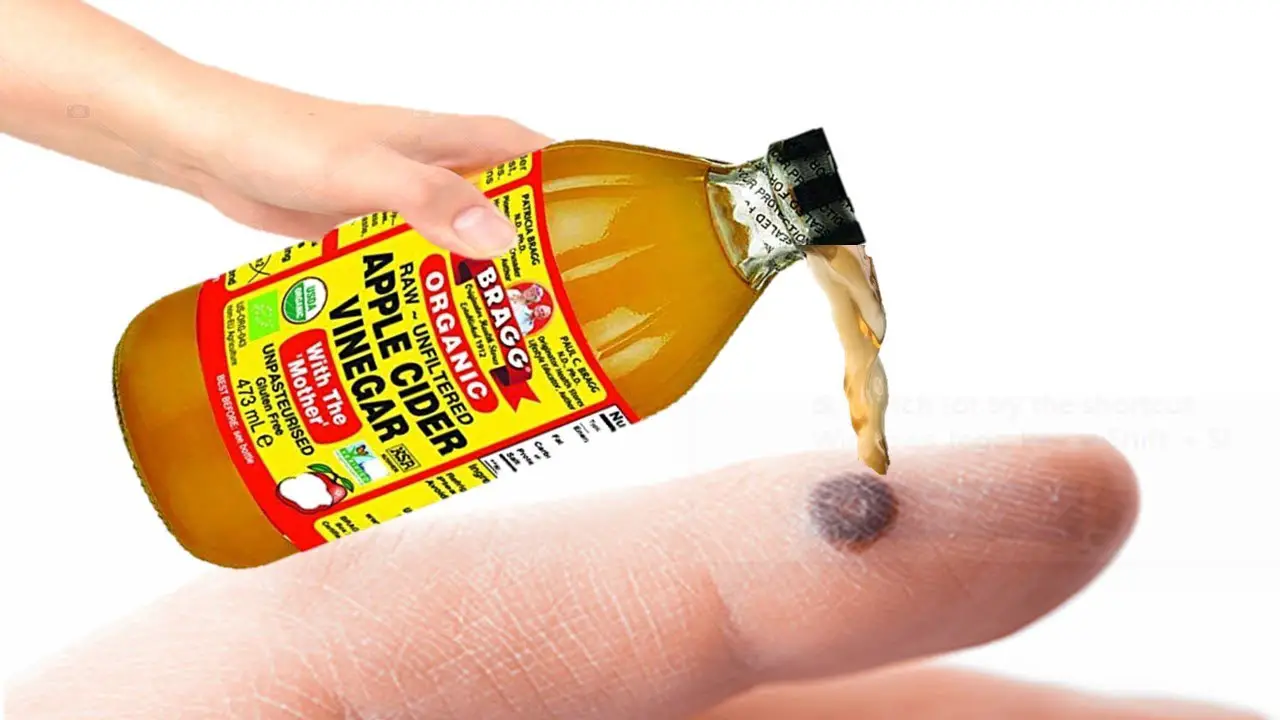 How To Get Rid Of Warts Using Apple Cider Vinegar Fast Epic Natural