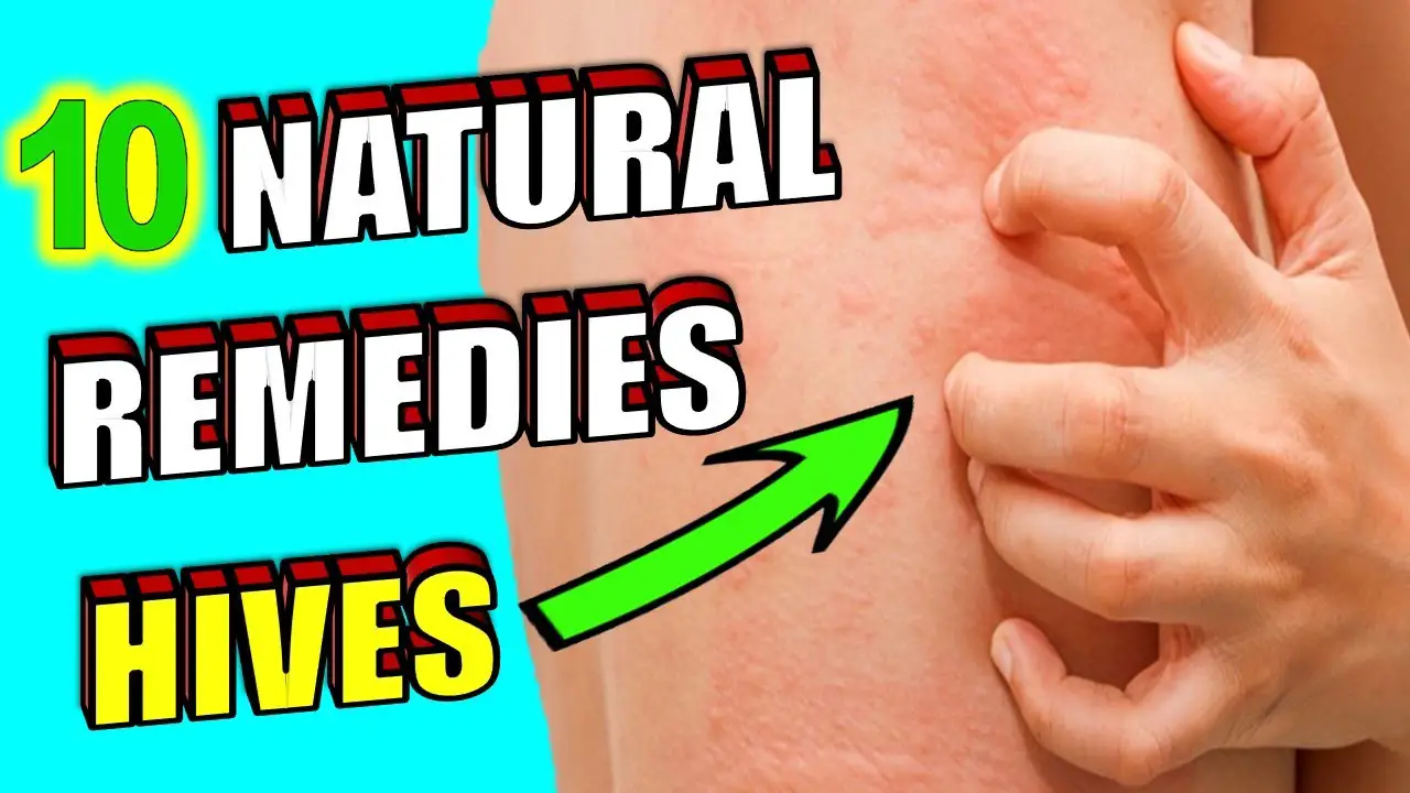 10 Natural Remedies For Skin Hives Treatment At Home What Are Skin