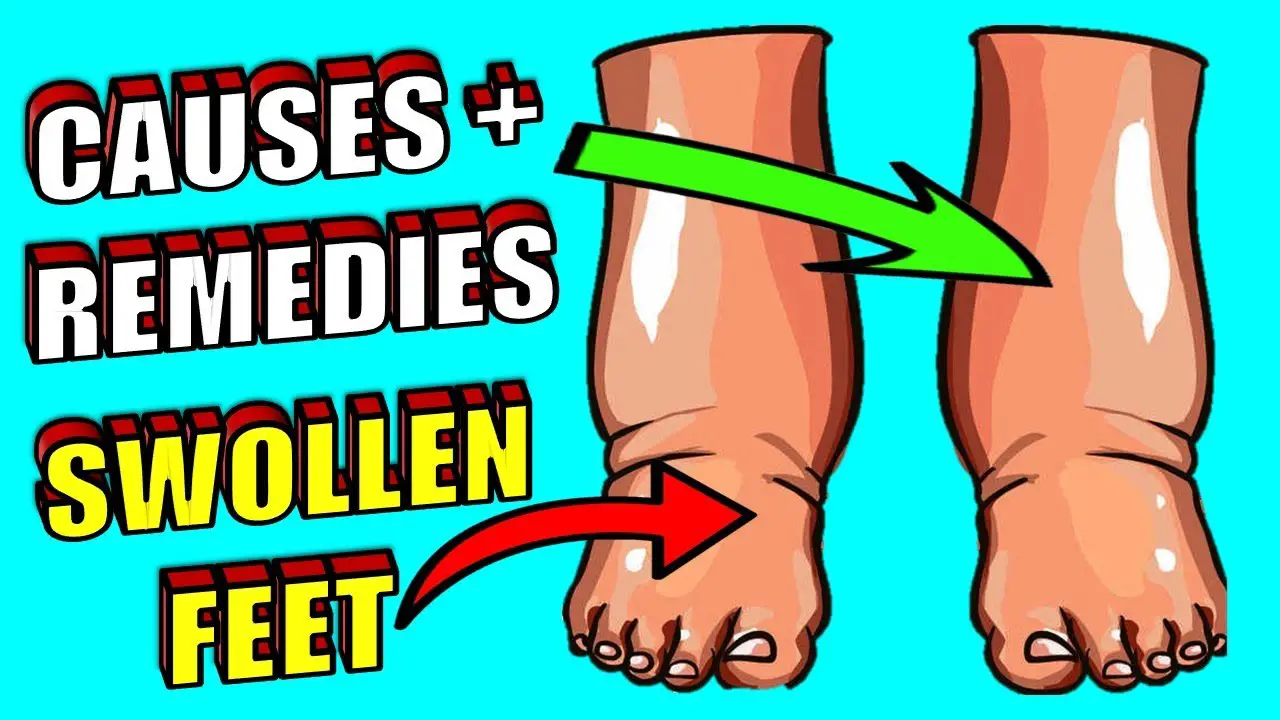 Causes And Home Remedies For Swollen Feet Epic Natural Health