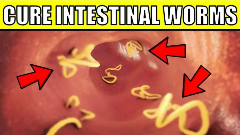 8 Natural Ways to Get Rid of Intestinal Worms - Epic Natural Health